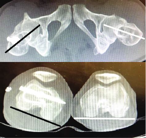 Ct Scans With Axial Cuts At The Level Of The Femoral Neck And The