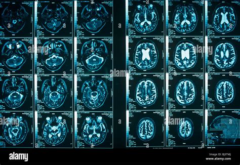 Detail Of A Magnetic Resonance Imaging MRI Scan Showing The Profiles Of A Human Cranium Stock