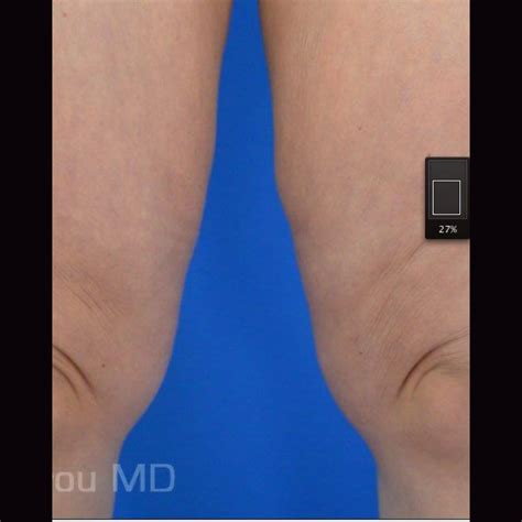 Thigh Lift Clinica Joia