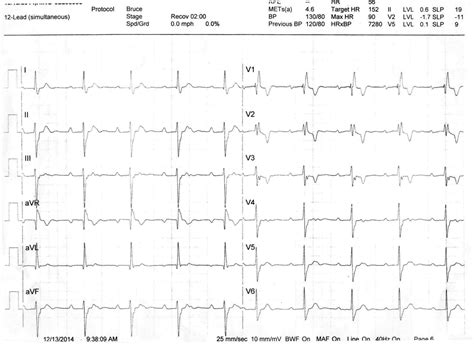 Trifascicular Block Progressing To Complete Av Block On Exercise A