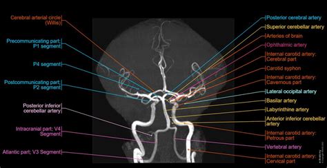 Time Of Flight Tof Mr Angiography Of The Brain