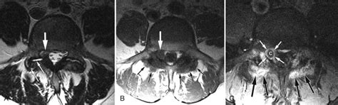 Disc Herniation Recurrent Vs Postoperative Scarring Radiology Key