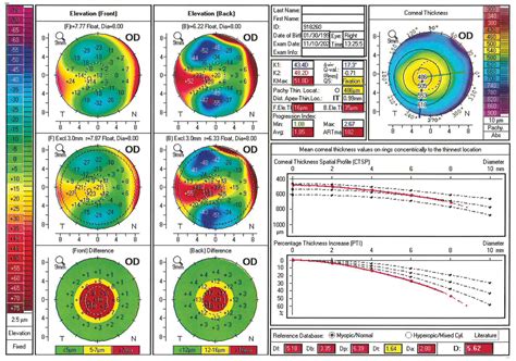 Lesson A New Consensus On Keratoconus