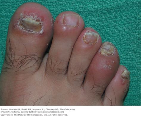 Keratoderma Blennorrhagicum