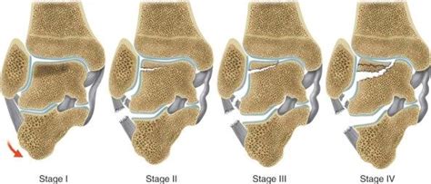 Acute Osseous Injury To The Ankle And Foot Clinical Tree
