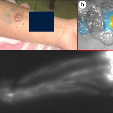 A Injection Site On Forearm B Fluorescent Sentinel Node C Download Scientific Diagram