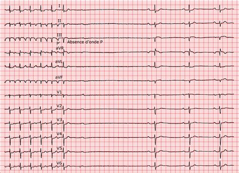 Av Nodal Reentrant Tachycardia Ecg