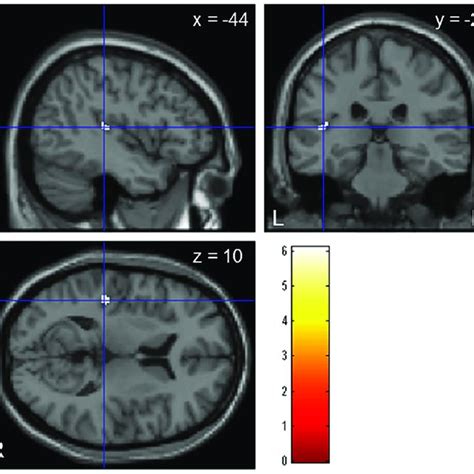 Voxel Based Morphometry Analysis In Patients With Multiple Sclerosis Download Scientific