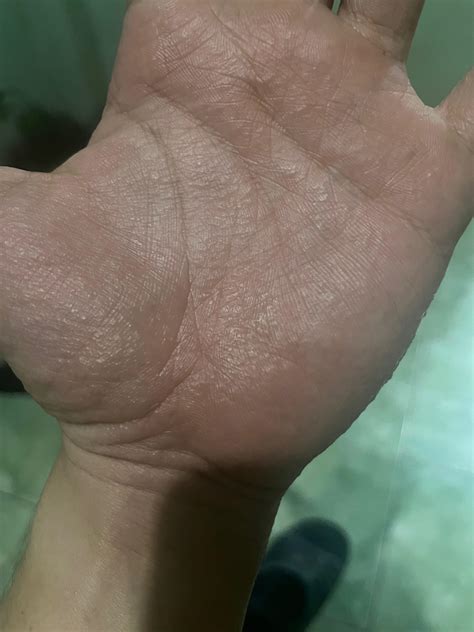 Is This Dyshidrosis Rdyshidrosis