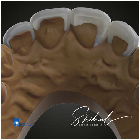 Smiledesign Dentalinnovation Dentaltech Shihabur Rahman