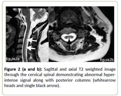 Spinal Cord B12 Deficiency