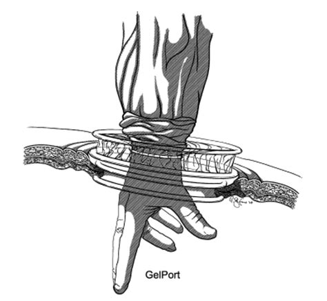 Laparoscopic Left Colectomy Including Sigmoid Colectomy kỹ thuật cắt đại tràng trái bao gồm