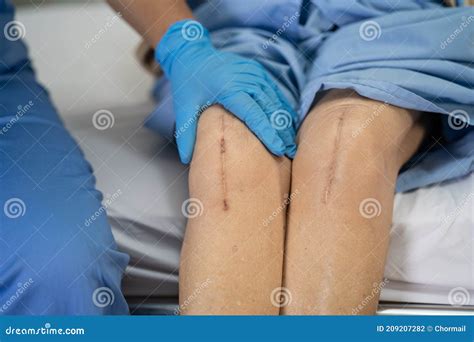 Asian Senior Or Elderly Old Lady Woman Patient Show Her Scars Surgical