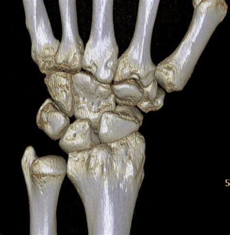Broken Scaphoid Democratiz3d® Processing