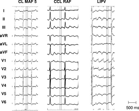 Surface Electrocardiogram Characteristics Of Atrial Tachycardias Occurring After Pulmonary Vein