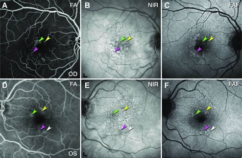 Multimodal Retinal Imaging Of Both Eyes 11 Months Before Death Download Scientific Diagram