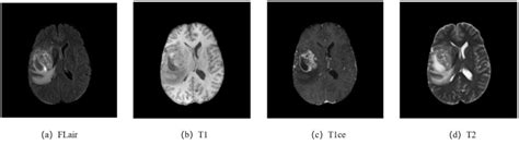 Figure From Brain Tumor MRI Segmentation Method Based On Segment Anything Model Semantic Scholar