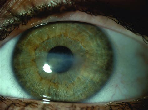 Corneal Neovascularization