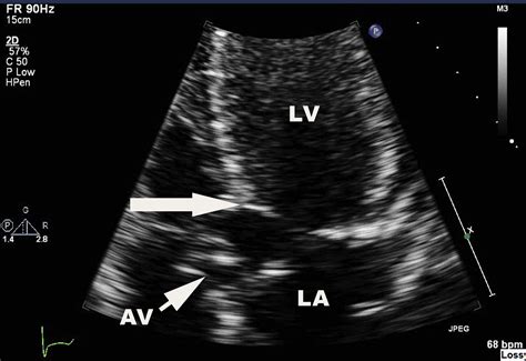 Subaortic Membrane And Hypertrophic Obstructive Cardiomyopathy In The Cardiac Catheterization