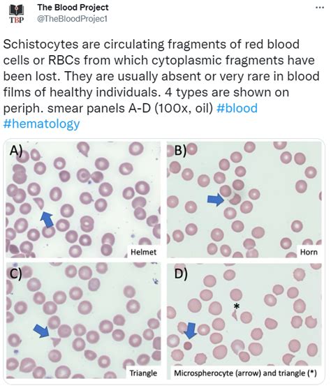 Schistocytes • The Blood Project