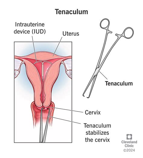 Tenaculum Gynecology Forceps Use Pain And Alternatives