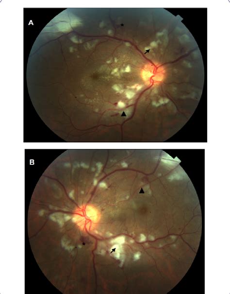 Fundus Of Right A And Left B Eyes Showing Intraretinal Haemorrhages Download Scientific
