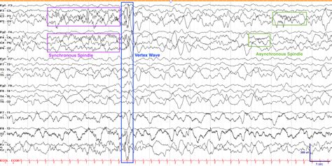 Normal Eeg Tracing