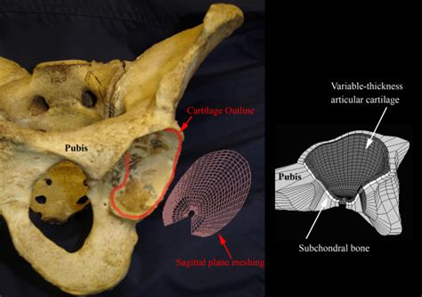 Acetabular Modeling The Region Of Cartilage Coverage Is Traced And