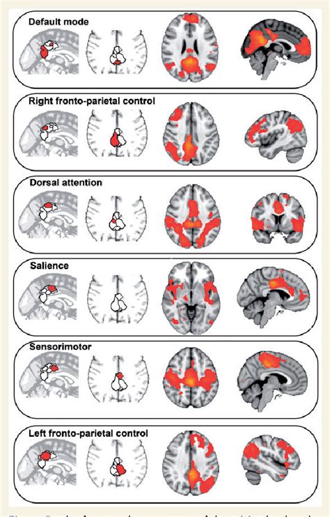 Figure 2 From The Role Of The Posterior Cingulate Cortex In Cognition And Disease Semantic