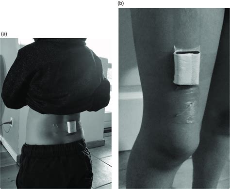 attachment sites on the body for the dual axivity ax3 accelerometer