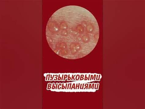 Все о герпесе - YouTube