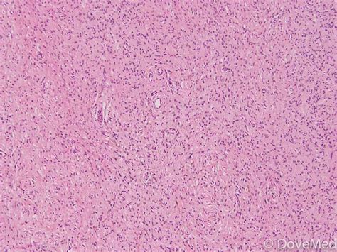 Diffuse Cutaneous Neurofibroma Dovemed