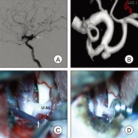 Pdf Management Of Aneurysms Of The Proximal A1 Segment Of The
