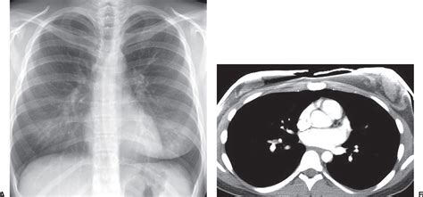 Unilateral Hyperlucent Hemithorax Radiology Key