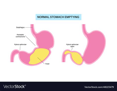 Gastroparesis Anatomical Poster Royalty Free Vector Image