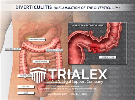 Anatomy Of Sigmoid Colon Showing Diverticulitis Trialexhibits Inc