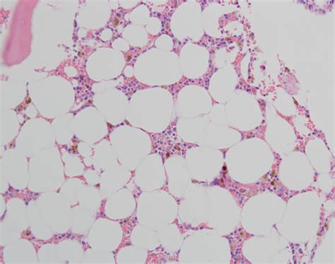 Bone Marrow Biopsy Core Biopsy Showing Hypocellularity Overall 10