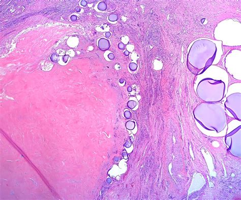 Embolized Uterus Pathosomes