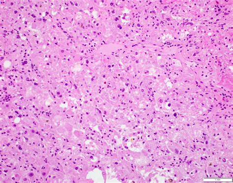 Renal Angiomyolipoma Gross