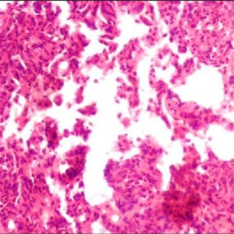 Photomicrograph Showing Patchy Interstitial Fibrosis And Chronic