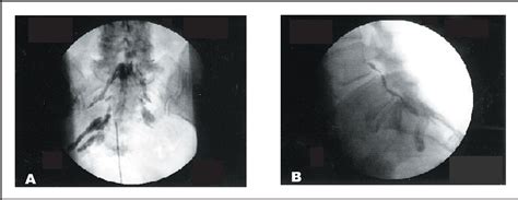 Figure 3 From Evaluation Of Fluoroscopically Guided Caudal Epidural Injections Semantic Scholar