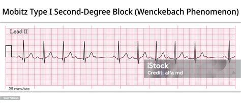 Wenckebach Phenomenon Ecg Mobitz Type 1 Second Degree Atrioventricular
