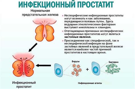 Chronic Prostatitis Antibiotic Treatment