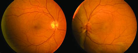 Two Years Later The Ophthalmic Fundus Examination Of The Left Eye