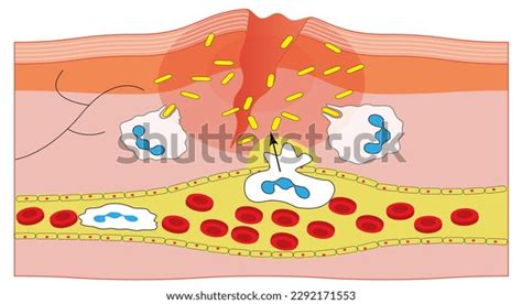 Categoría «inflammatory Capillary Response De Fotos Imágenes E Ilustraciones Shutterstock