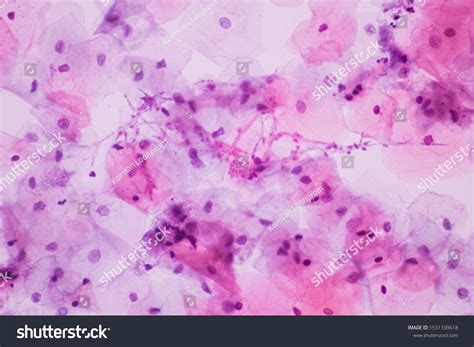 Vaginal Candidiasis Slide