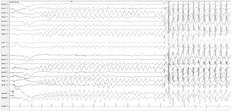 Eeg In Focal And Generalized Epilepsies Pearls And Perils Epilepsy