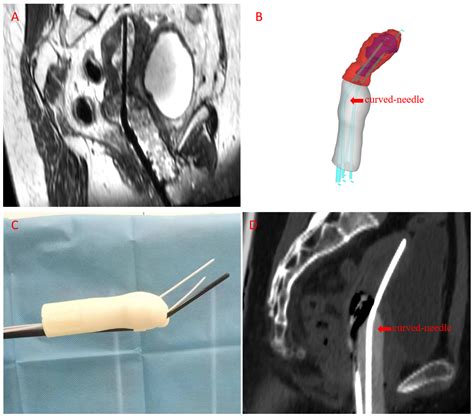 A Novel Three Dimension Printed Individualized Curved Needle Based