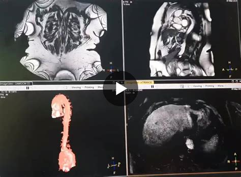 Case Of Aortic Aneurysm Mr Aortography Non Contrast Mohamed Gamal Elharoun