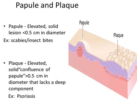 Papules Vs Vesicles